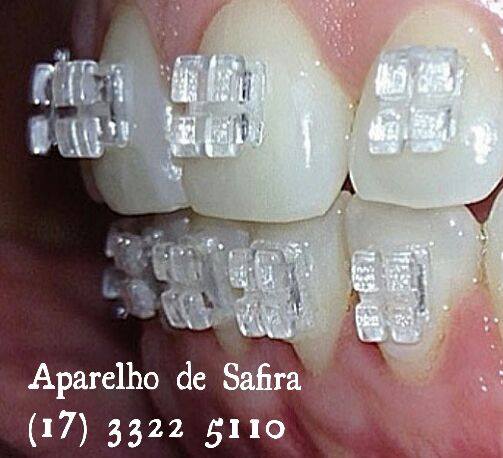 Aparelho Estético Transparente em Piracicaba | Orthoway Clínica ...